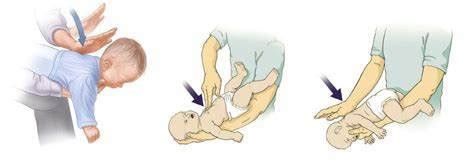 Cómo Hacer La Maniobra De Heimlich En Niños Y Adultos