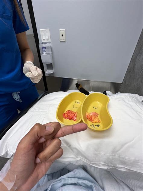 Experience With Kenalog Steroid Injection Post Surgery To Remove Scar Tissue Gynecomastia