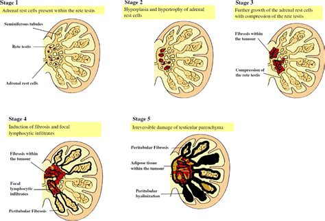 Testicular Adrenal Rest Tumor In A Pediatric Patient With Congenital