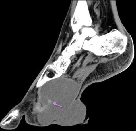 Breast Metastasis Of Extraskeletal Myxoid Chondrosarcoma A Case Report Abstract Europe Pmc