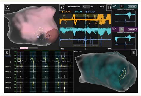 Figure 1 From Clinical Utility Of Non Contact Charge Density ‘supermap Algorithm For The