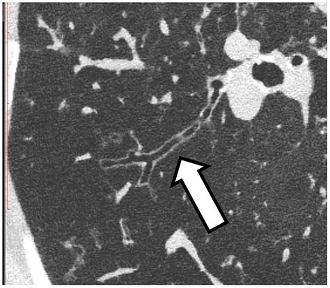 Clinical Applications Of Photon Counting Detector Ct Pmc