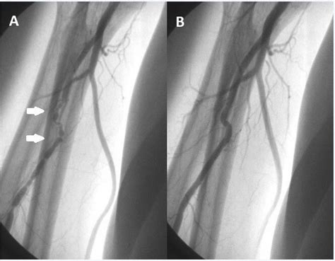 Severe Diffuse Spasm White Arrows Of The Radial Artery A Which