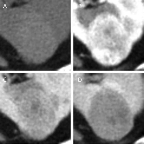 Algorithm Differentiates Small Renal Masses On Multiphase Ct
