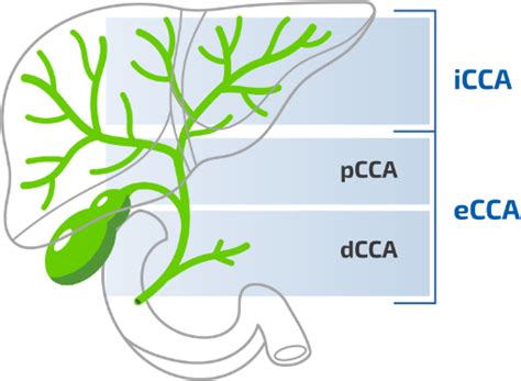 What Is Intrahepatic Cholangiocarcinoma Icca