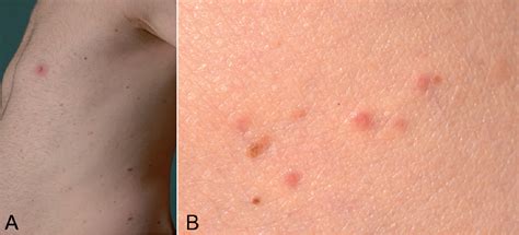 Pruritic Papular Eruption