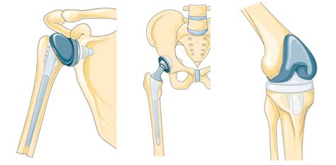 Эндопротезирование сустава в СПБ цена операции в ГБУЗ ЛОКБ