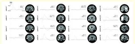 Differential Tms Eeg Responses In The Subgroup Of Patients With No Download Scientific Diagram