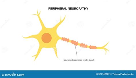 Peripheral Neuropathy Medical Poster Vector Illustration