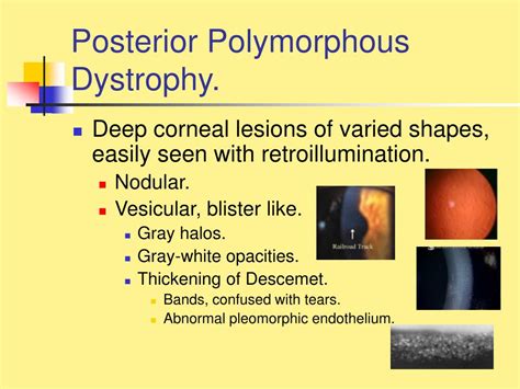 Ppt Glaucoma And Primary Disorders Of The Endothelium Powerpoint