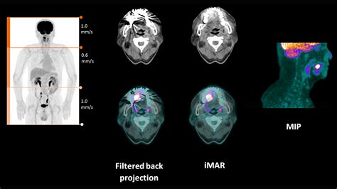 Imar Iterative Metal Artifact Reduction Siemens Healthineers