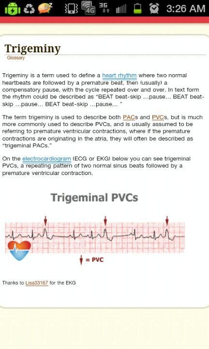 Ekg Trigeminy Nurse Quotes Nursing Mnemonics Nursing Notes