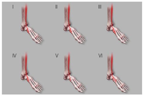 Tibialis Anterior Tendon Tear