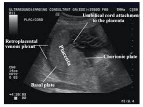 Plancenta Flashcards Quizlet