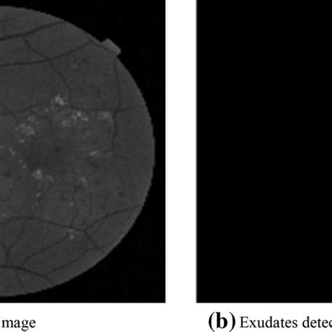 A Input Image B Exudates Detected Download Scientific Diagram