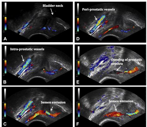 Pdf Perineal Ultrasound A Review In The Context Of Ejaculatory