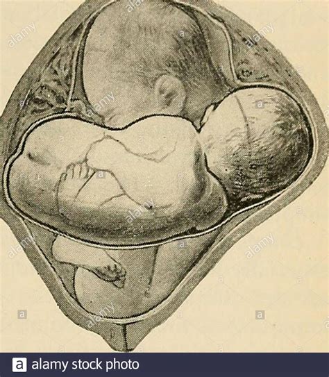 Spinning Babies Breech Twins At Rick Weiss Blog