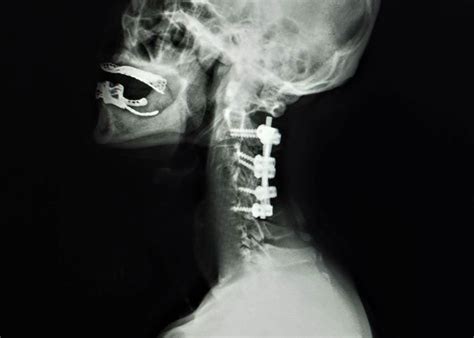 Posterior Cervical Decompression And Fusion Spine Surgeon Clear Lake Houston Sugar Land Tx