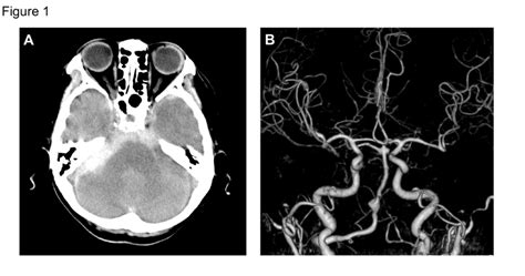 A Computed Tomography Imaging Shows A Subarachnoid Hemorrhage B Download Scientific Diagram