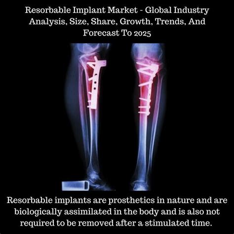 Xpodence Research On Linkedin Resorbable Implant Market Are Utilized
