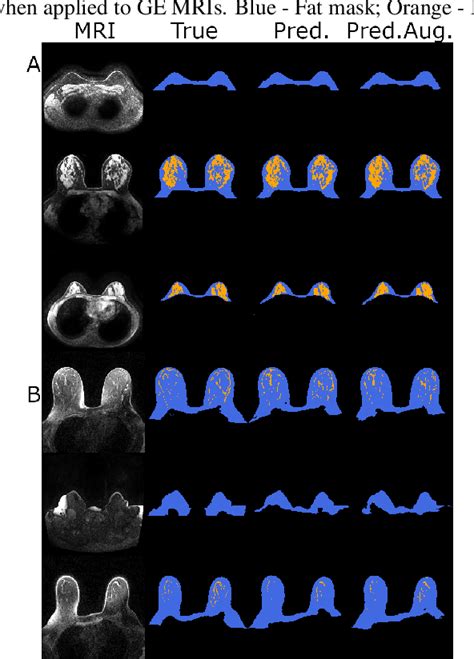 Counterfactual Mri Data Augmentation Using Conditional Denoising Diffusion Generative Models