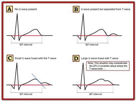 Online QTc Calculator For Normal And Wide QRS LBBB RBBB Etc Dr Smiths ECG Blog
