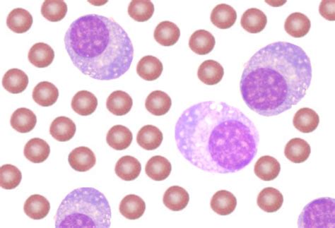Plasma Cell Leukemia Wikipedia