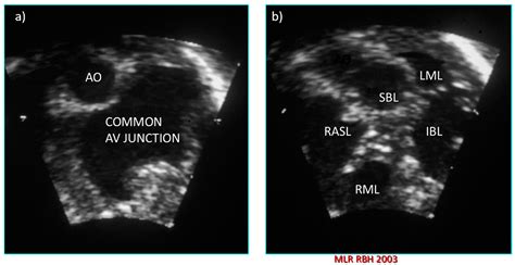 Endocardial Cushion Defect Echo