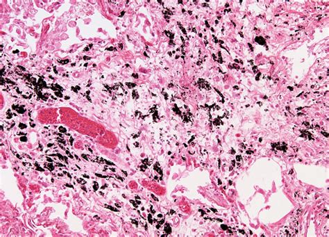 Toxoplasmosis At 10x Magnification Nikons Microscopyu