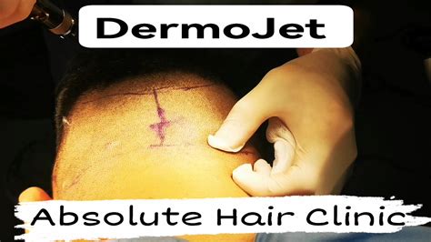 Dermojet Needleless Local Anesthetic Administration คนมักกลัวเข็มตอนฉีดยาชาก่อนปลูก ผมหรือทำ