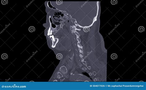 A Ct Scan Of The Neck Sagittal View For Diagnostic Technique Is