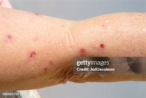 Medical Vesicular Dermatitis Sun And A Perscription Drug Reaction High
