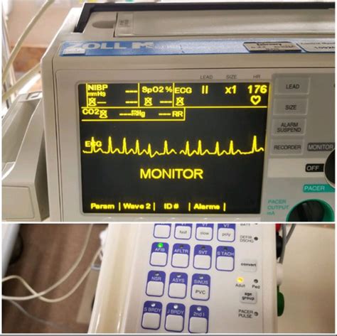 Cardio Version Waveforms Flashcards Quizlet