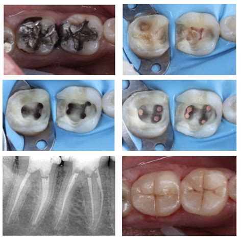 Root Canal Or Tooth Extraction