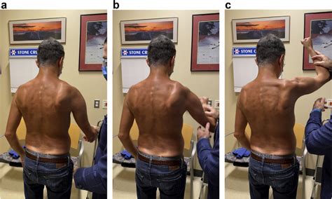 Shoulder Flexion Against Resistance Test Sfrt Positive At A 30 B