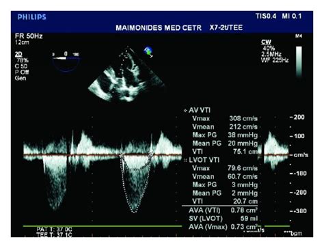 Tee Image Of The Deep Transgastric Long Axis Deep Tg Lax View