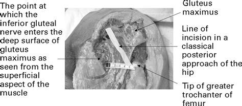 The Course Of The Inferior Gluteal Nerve In The Posterior Approach To The Hip Bone And Joint