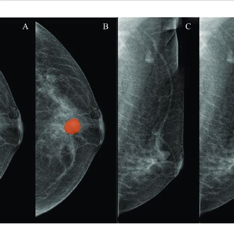 Examples Of Mammographic Masses Masking On Digital Mammography Download Scientific Diagram