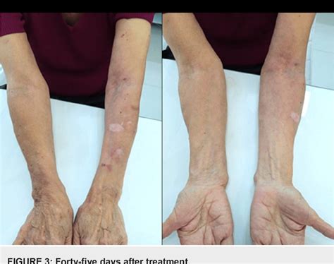 Figure 3 From Dermatoporosis In Upper Limbs Treated With