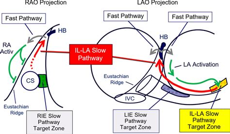 Slowfast Atrioventricular Nodal Reentrant Tachycardia Using The