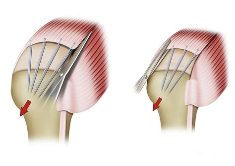Rotator Cuff Repair Stock Image C Science Photo Library My Xxx Hot Girl