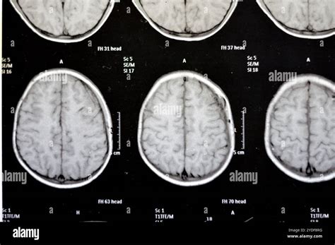 Mri Of The Brain Reveals Previous Shunt Operations For A Hydrocephalus Case Right Frontal Pre