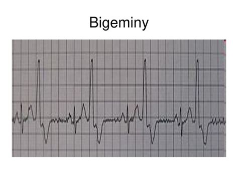 Electrocardiographic Monitoring Ppt Download