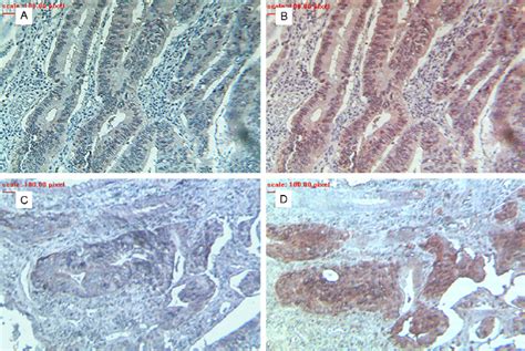 Expression Levels Of 4e Bp1 And P4e Bp1 In Adenocarcinoma Tissues The Download Scientific