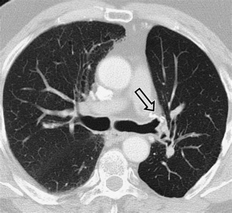What Is Lung Field Lucency At Mark Bevill Blog