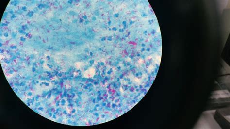 Ajmiya Siyad On Linkedin Acid Fast Bacilli Afb Smear