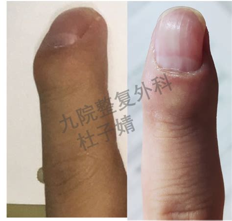 手指纽扣畸形图片 纽扣指畸形图片 第4页 大山谷图库