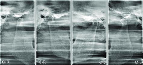 Lateral Temporomandibular Joint Image O R Right Temporomandibular Download Scientific Diagram