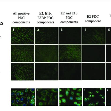 Representative Cytoplasmic Reticular Patterns Observed By Iif Hep 2 Download Scientific