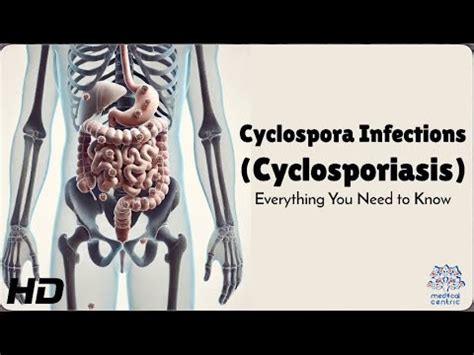 Cyclospora Infection The Parasite You Didnt Know About Youtube